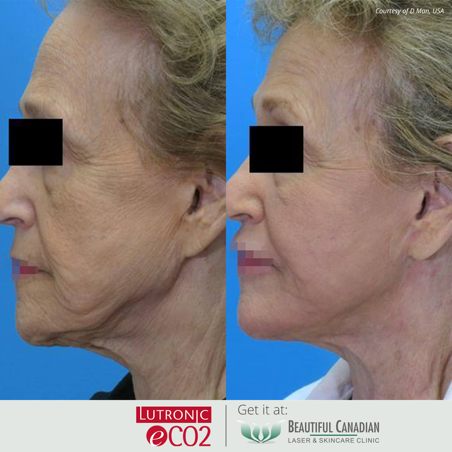 Vancouver Fractional CO2 Laser | Skin Resurfacing Surrey, Delta, Langley