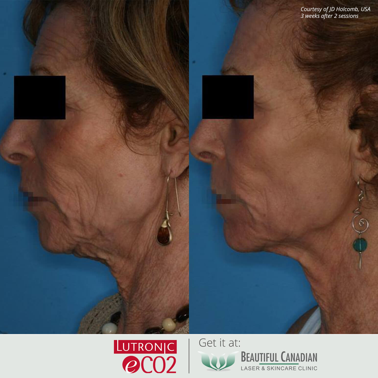 Vancouver Fractional CO2 Laser | Skin Resurfacing Surrey, Delta, Langley