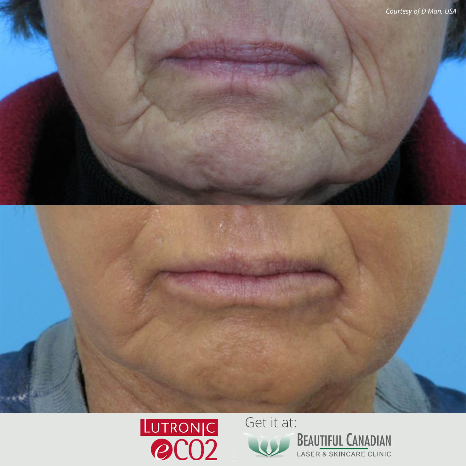 Vancouver Fractional CO2 Laser | Skin Resurfacing Surrey, Delta, Langley