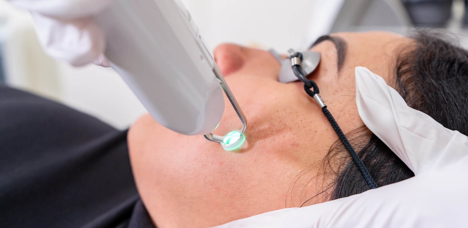 Your Guide to Effective Laser Active Acne Treatment Nearby