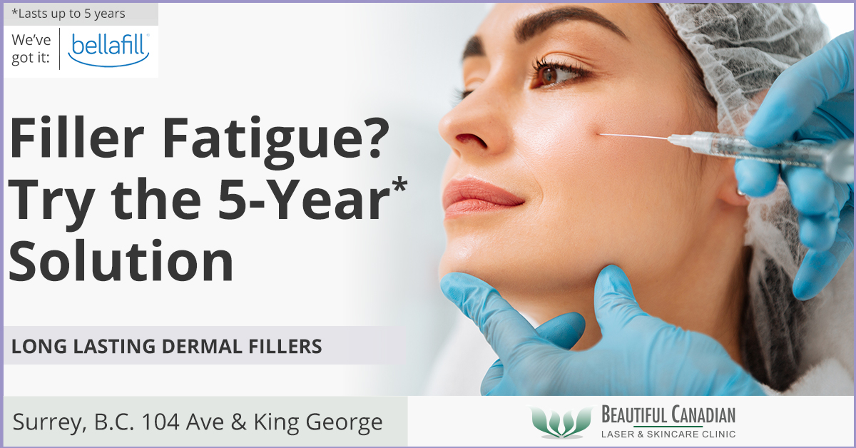 Vancouver Bellafill® Long Lasting Filler | Surrey, White Rock, Langley ...