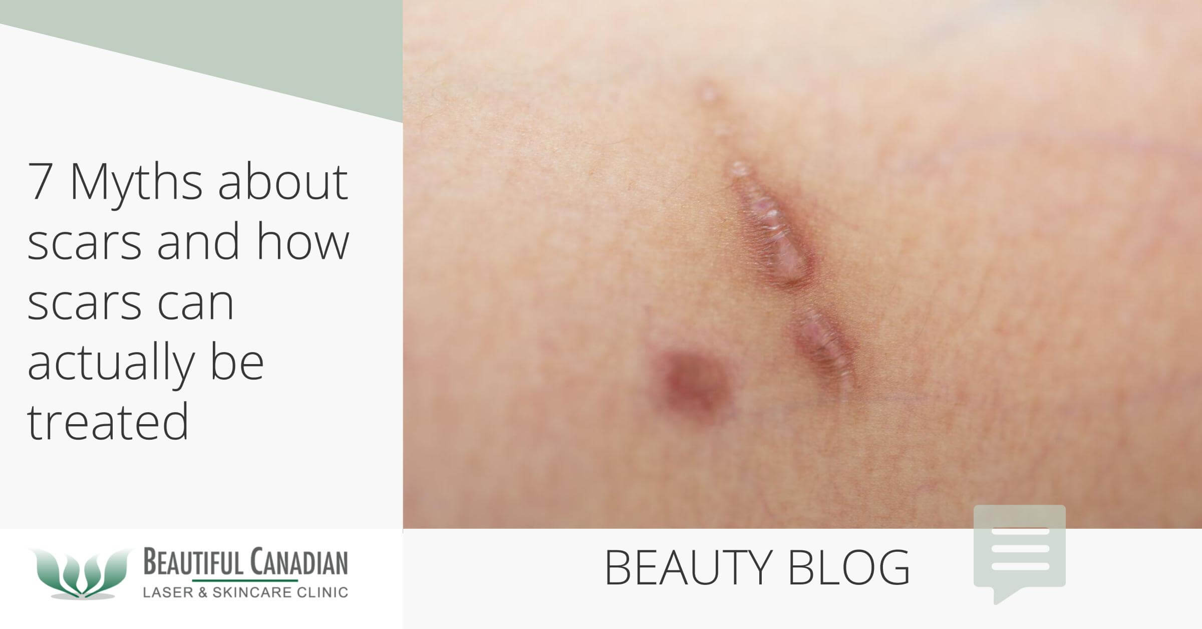 7 Myths About Scars & How Scars Can Actually Be Treated