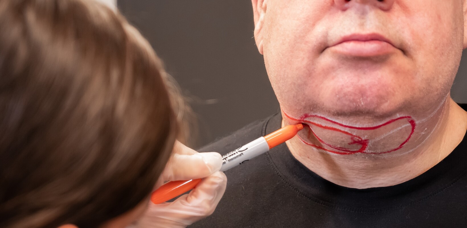 Surrey Chin Fat Reduction | No Surgery | Remove Double Chin Vancouver