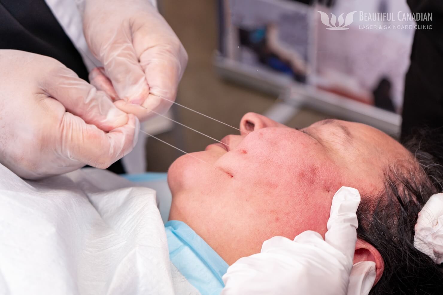 Why Are Thread Lifting Facelifts So Popular Now?